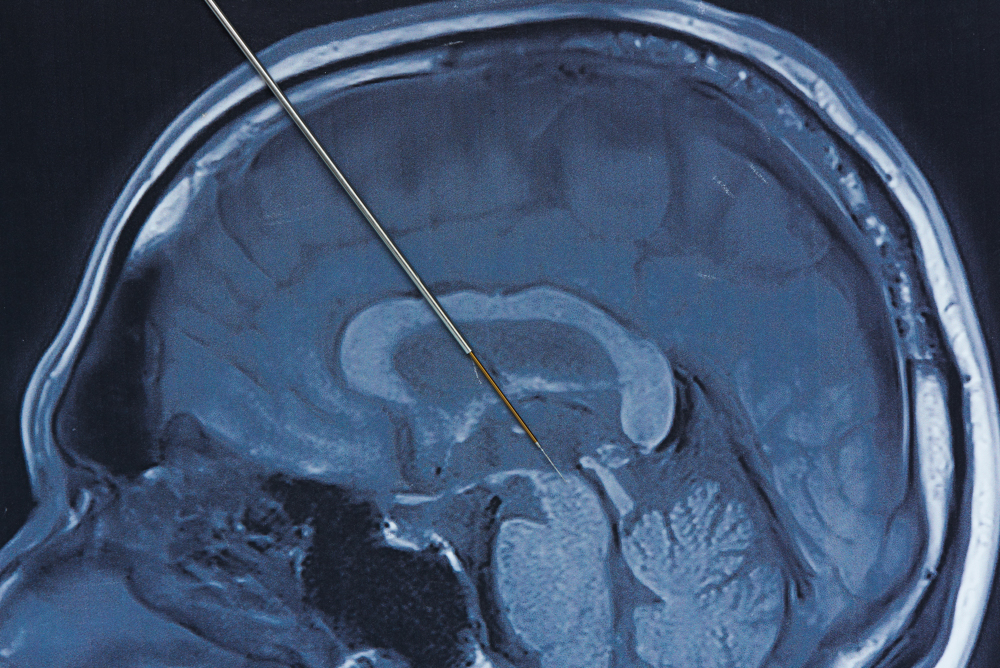 Minimally Invasive Cranial Base Surgery | Jefferson Health
