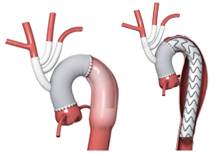Aortic Care | Jefferson Health