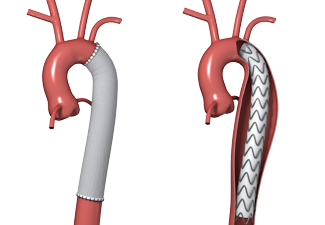 Aortic Care | Jefferson Health