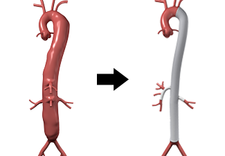 Aortic Care | Jefferson Health