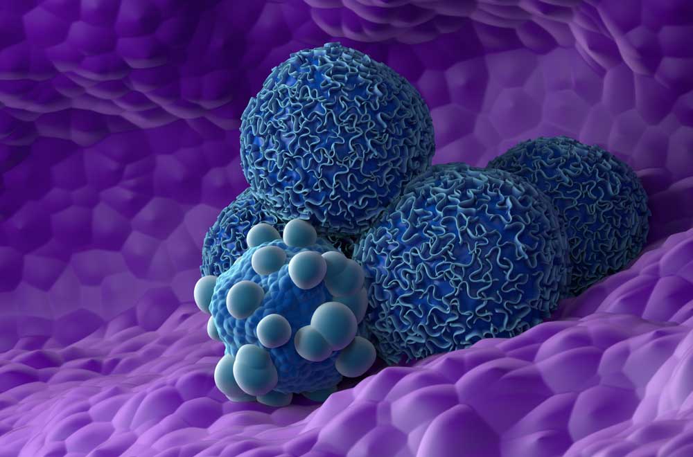 Overcoming Resistance to Chemotherapy in Pancreatic Cancer | Jefferson ...