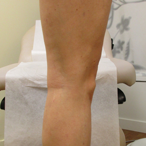 Vein Care - Gallery | Jefferson Health