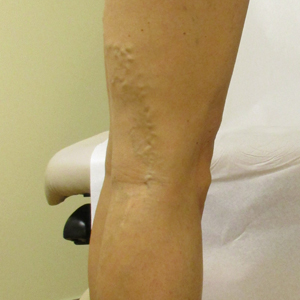 Vein Care - Gallery | Jefferson Health