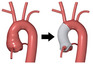 Aortic Care | Jefferson Health
