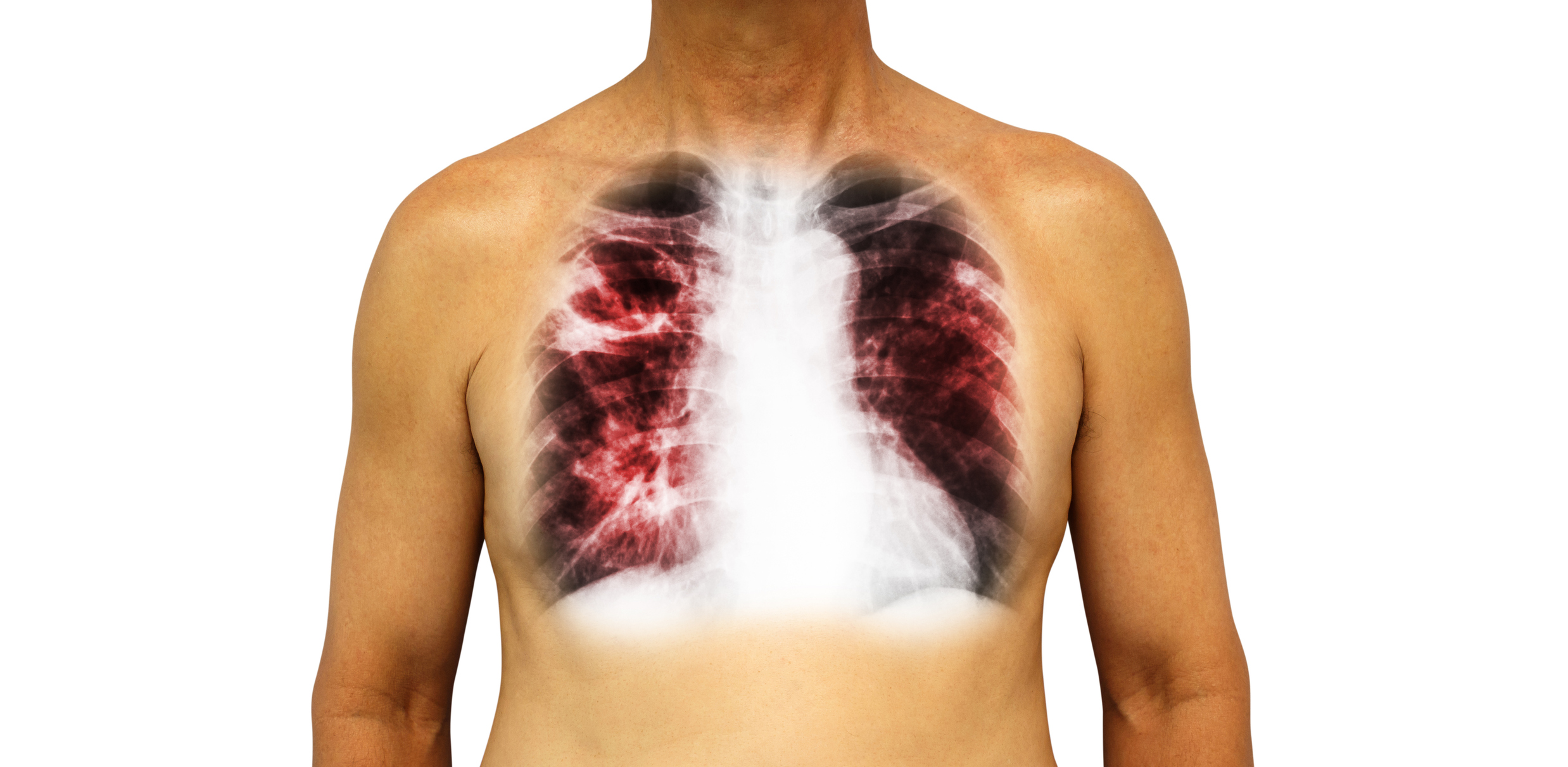 Interstitial Lung Disease (ILD) | Jefferson Health