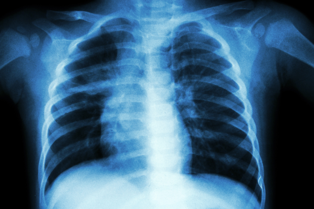 Tuberculosis Positive X Ray