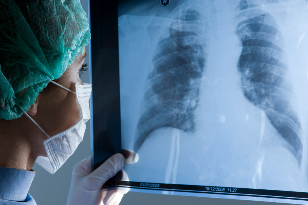 Can Chest X Ray Show Cancer