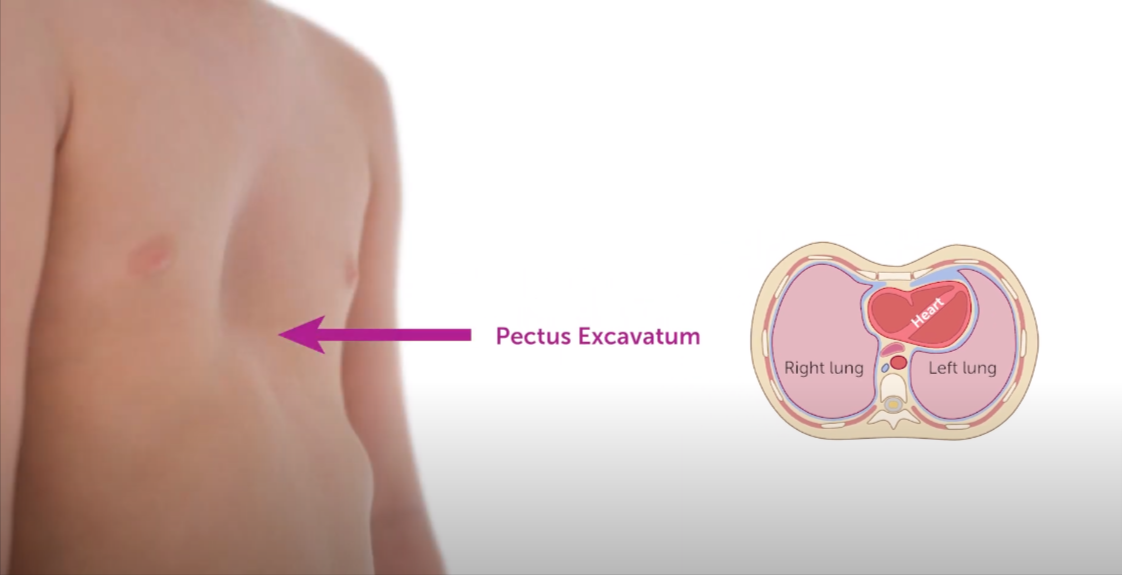 Pectus Excavatum | Jefferson Health